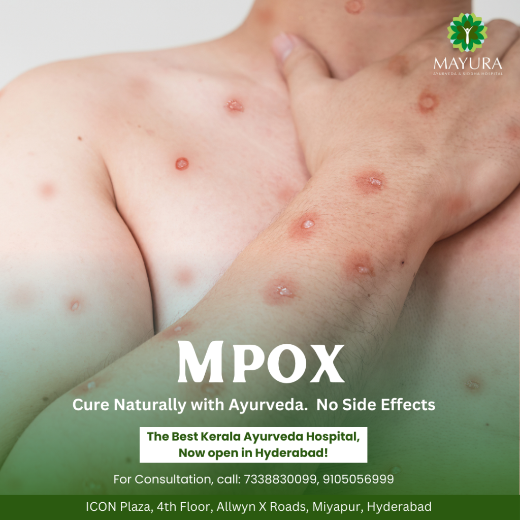 Mpox: Understanding the Virus & Mayura Ayurveda & Siddha Hospital's ...